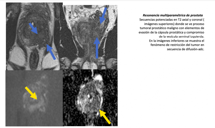 Resonancia Multiparamétrica de Próstata - Centro de Alta Tecnología